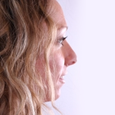Tummy Tuck and Lipo Patient 54 - North Texas Plastic Surgery