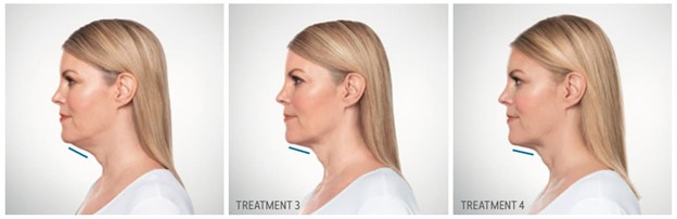 Everything You Need to Know About Allergan Injectable Products