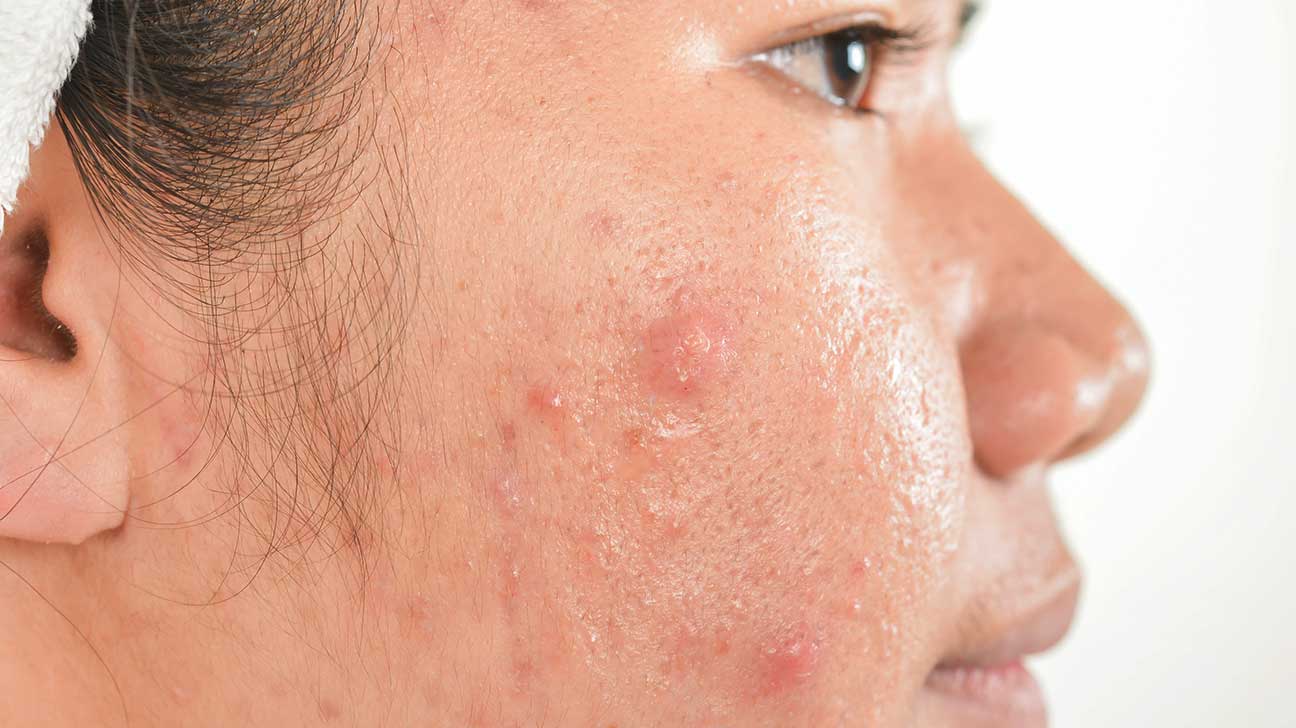 How to Get Rid of Acne Scars - North Texas Plastic Surgery