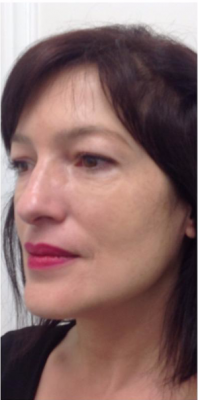 Before and After: Fillers To The Cheeks Patient #1 - North Texas ...