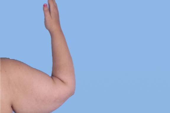 Arm Lift Before and After Photos